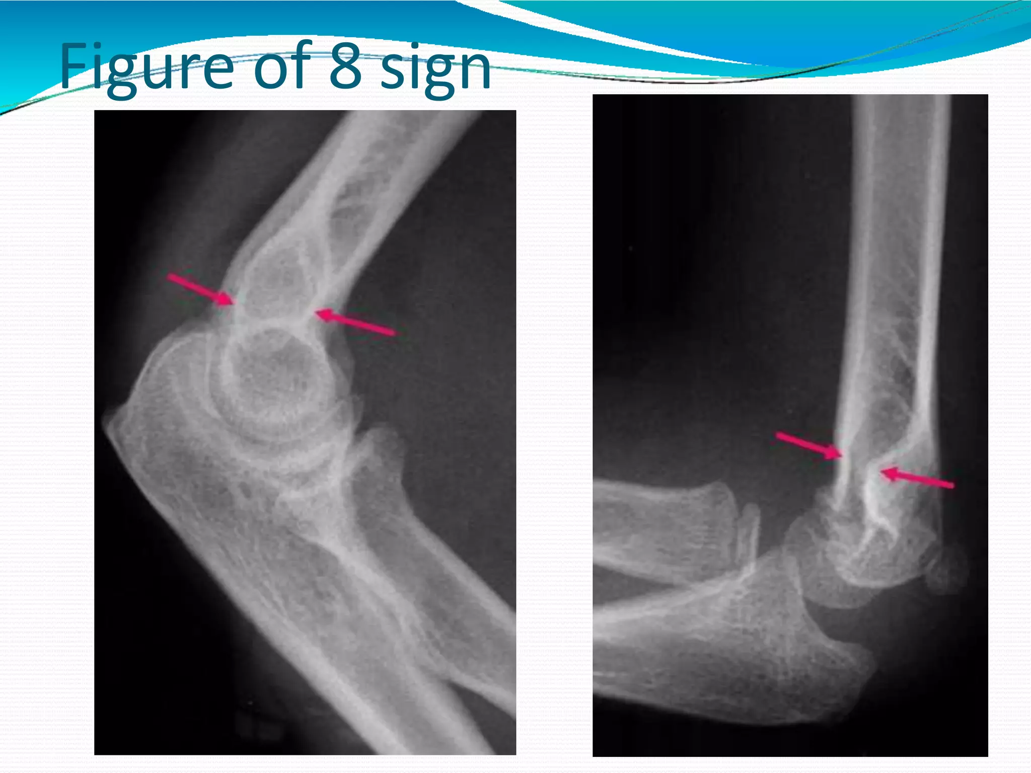 Distal humerus fracture in pediatrics by dr ashutosh | PPT