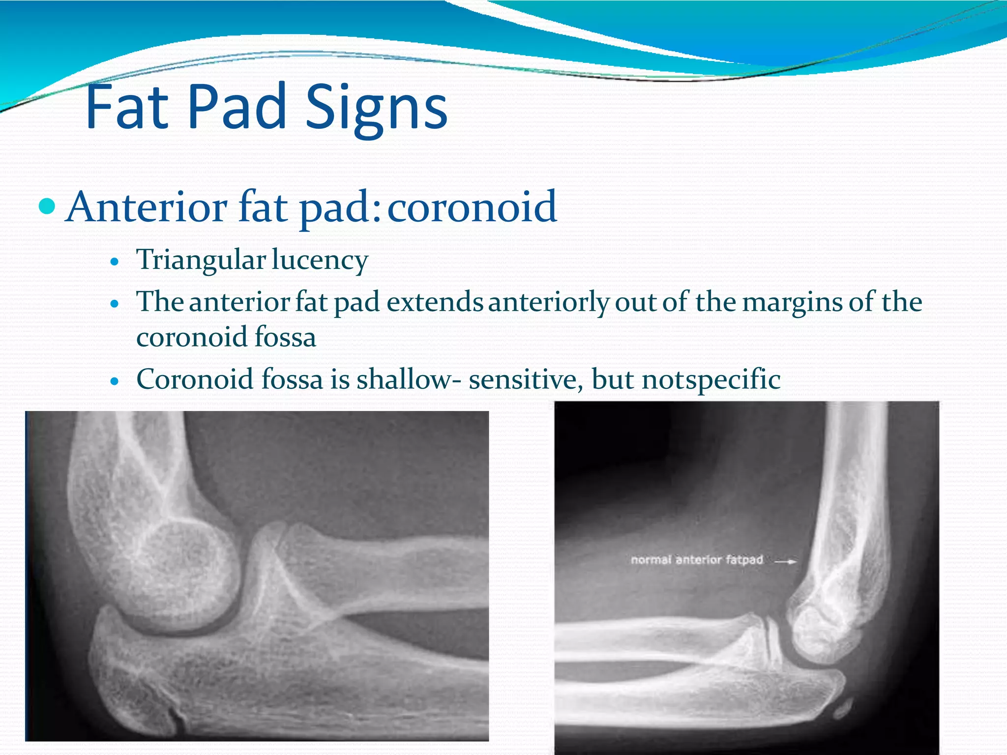 Distal humerus fracture in pediatrics by dr ashutosh | PPT