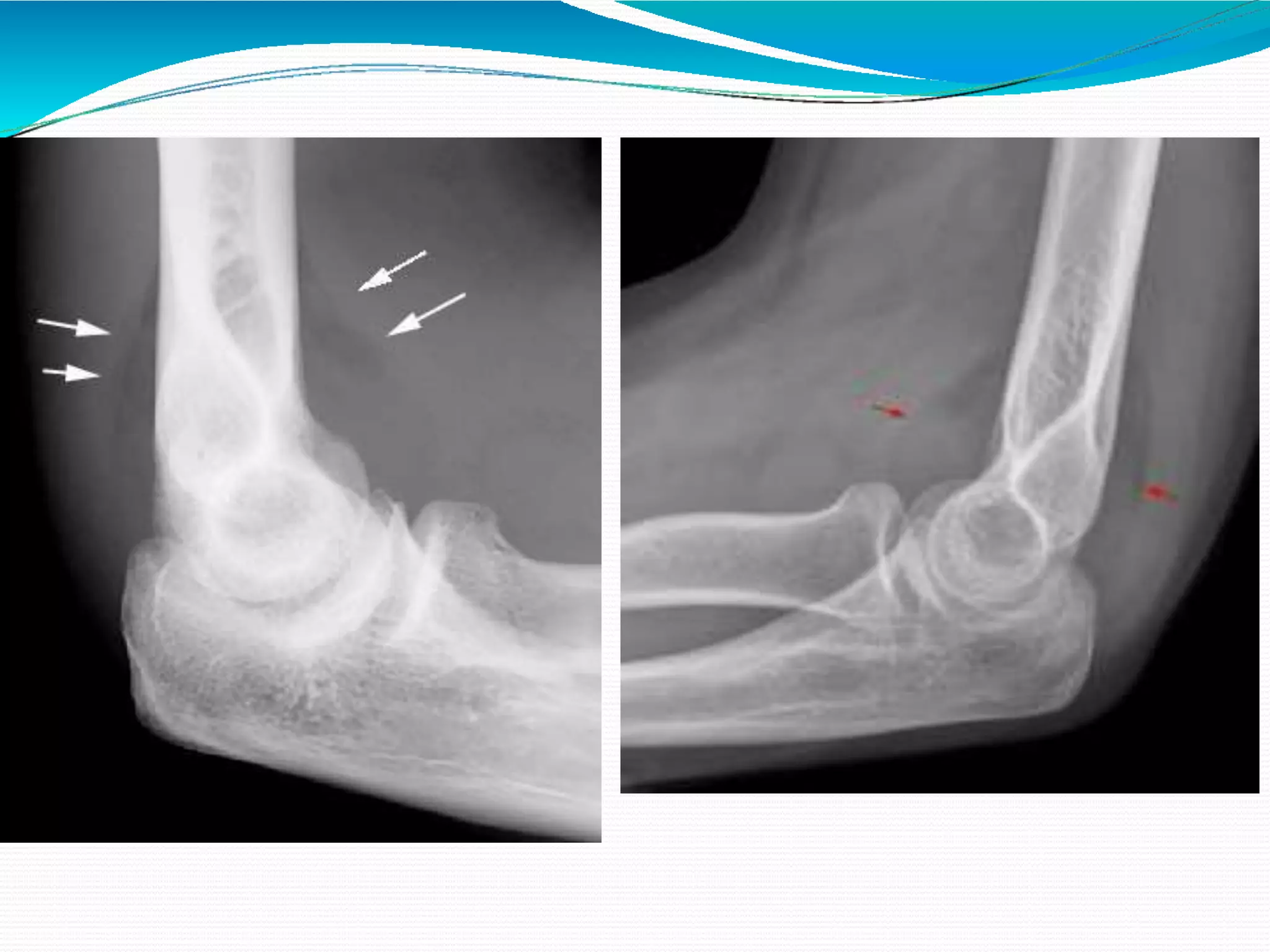 Distal humerus fracture in pediatrics by dr ashutosh | PPT
