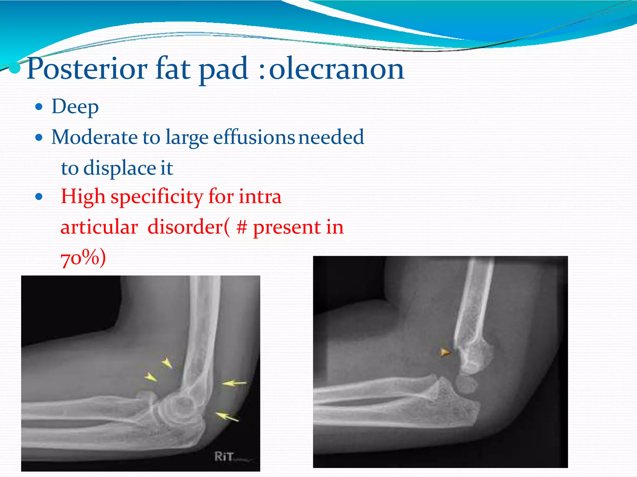 Distal humerus fracture in pediatrics by dr ashutosh | PPT