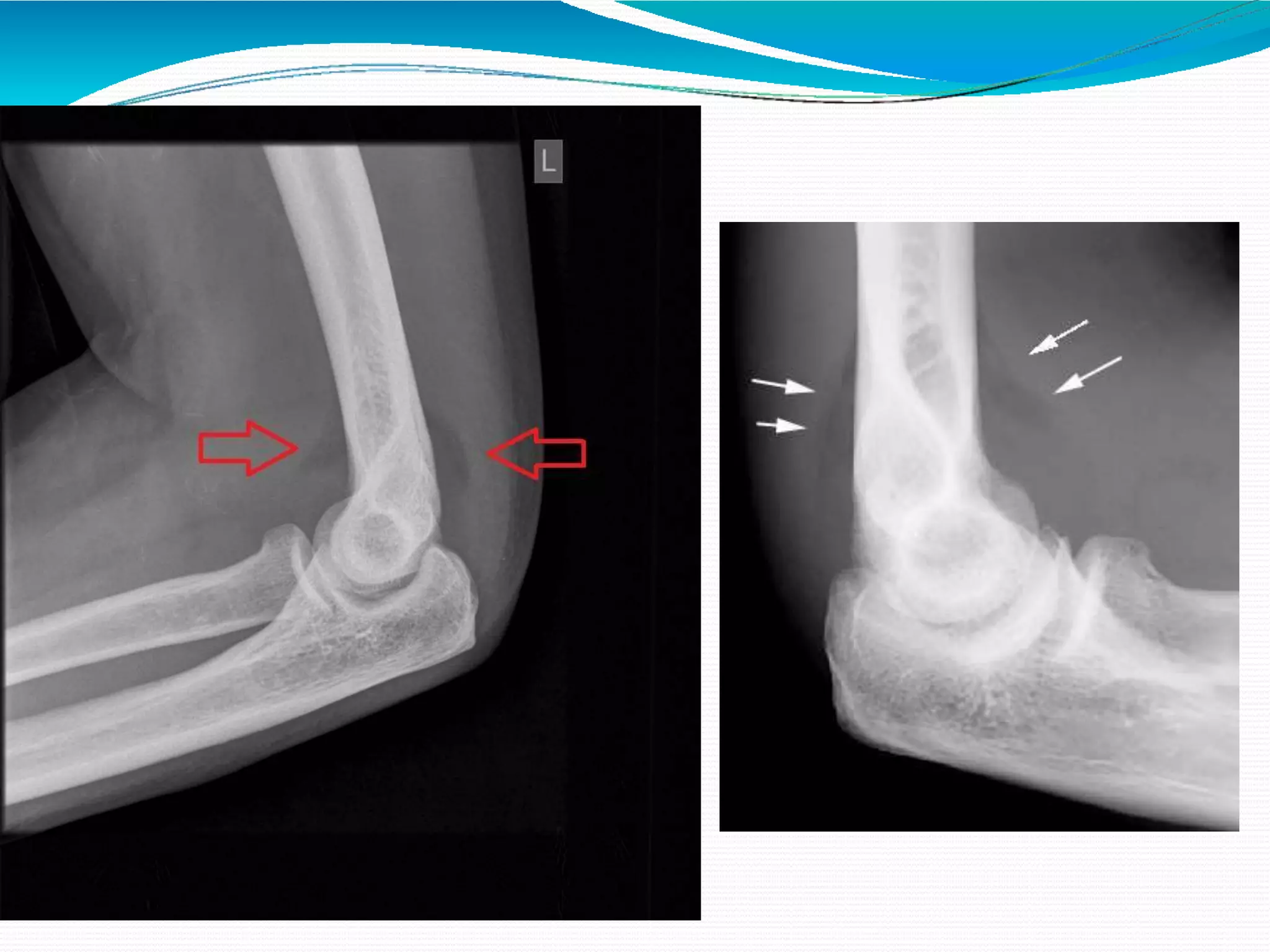 Distal humerus fracture in pediatrics by dr ashutosh | PPT