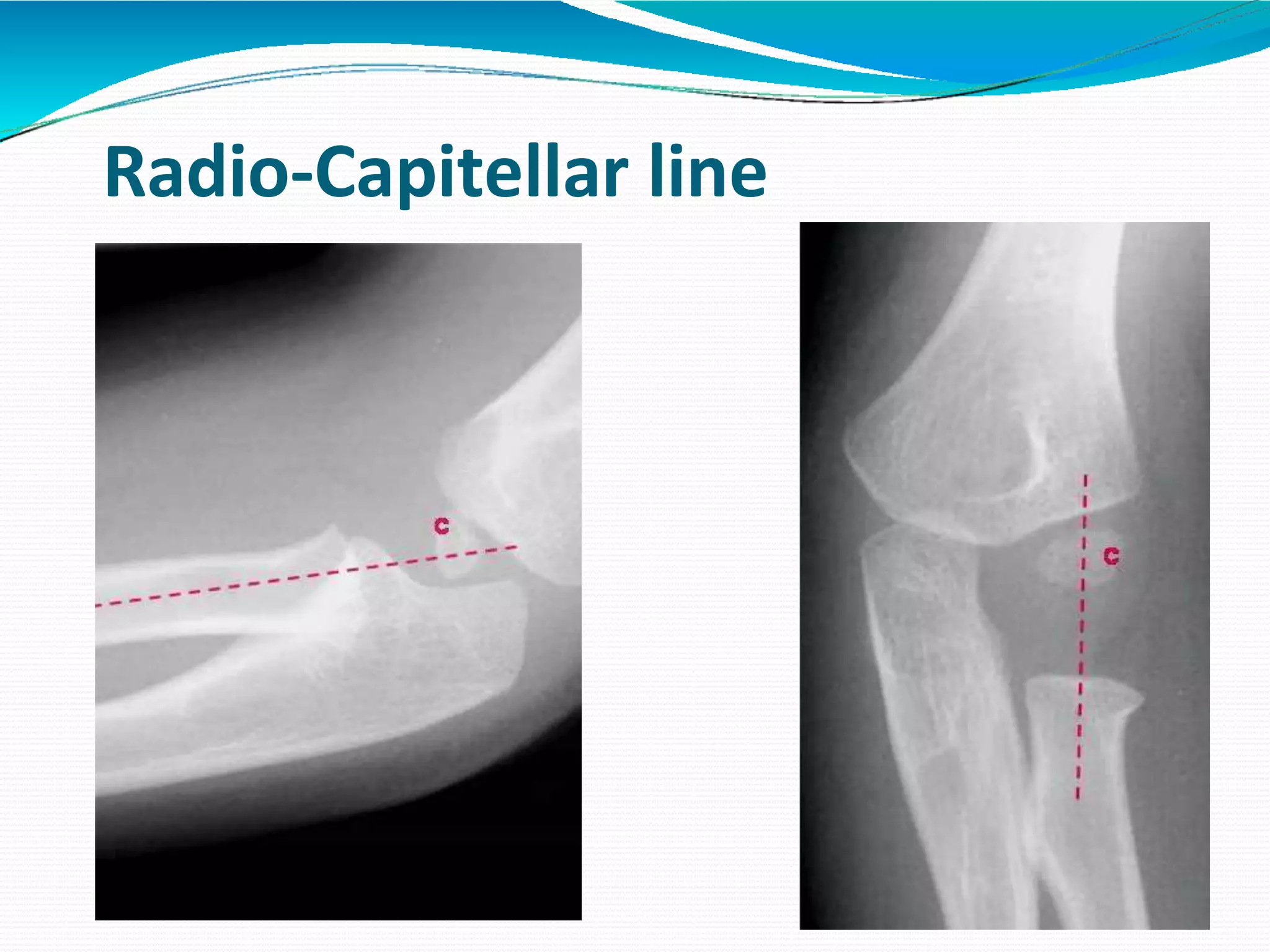 Distal humerus fracture in pediatrics by dr ashutosh | PPT
