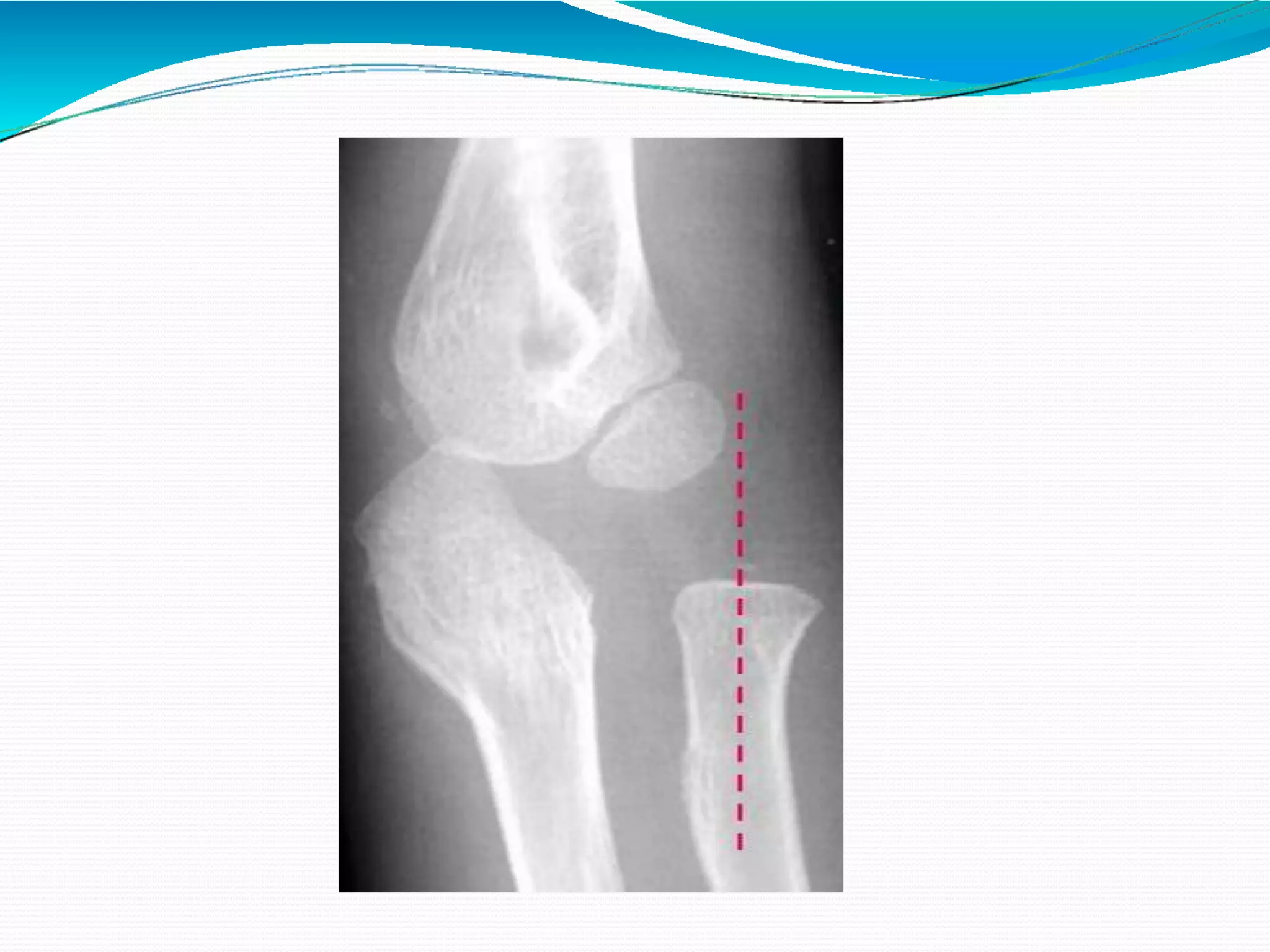 Distal humerus fracture in pediatrics by dr ashutosh | PPT