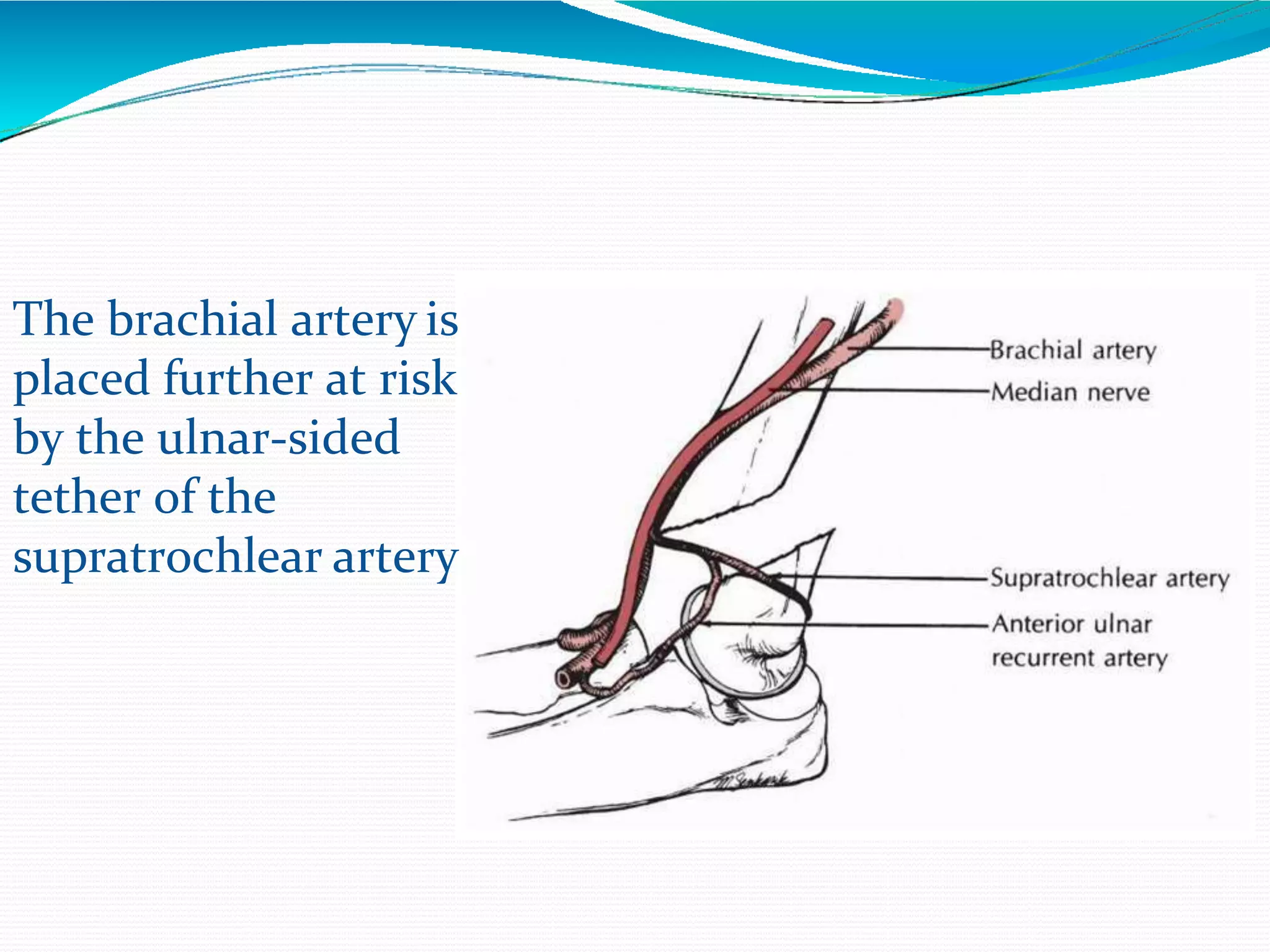 Distal humerus fracture in pediatrics by dr ashutosh | PPT