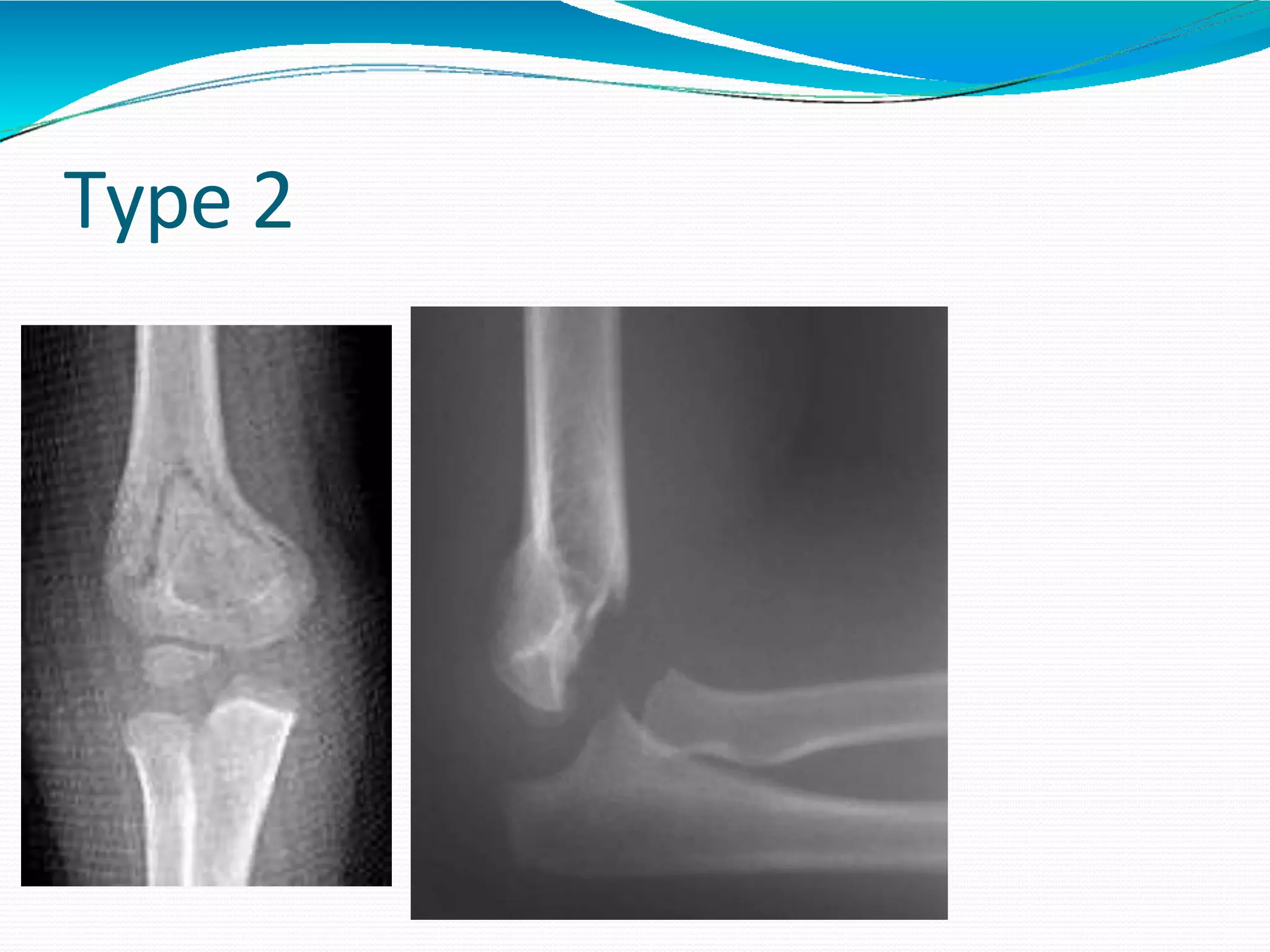 Distal humerus fracture in pediatrics by dr ashutosh | PPT