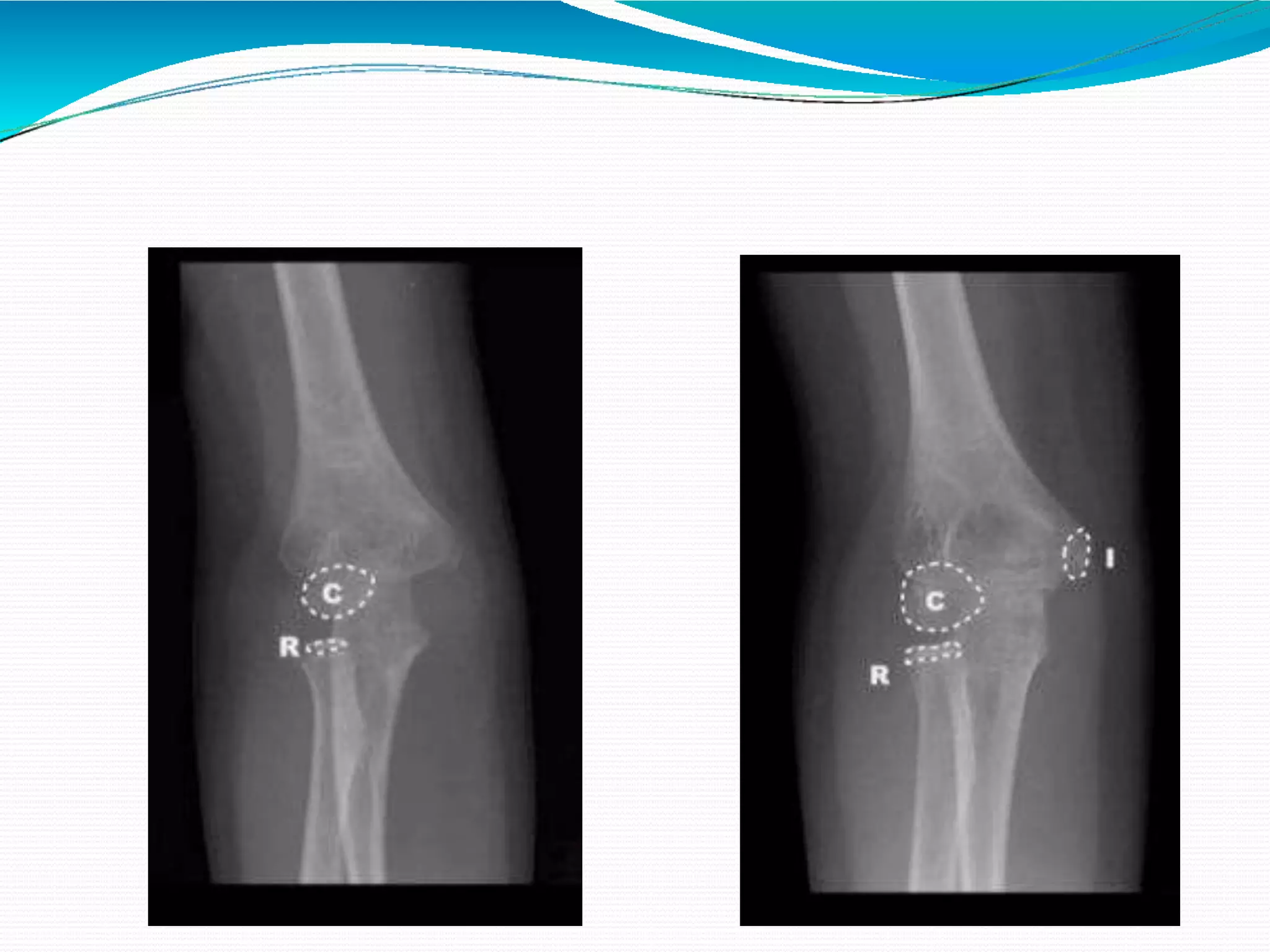 Distal humerus fracture in pediatrics by dr ashutosh | PPT