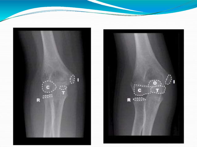 Distal humerus fracture in pediatrics by dr ashutosh | PPT
