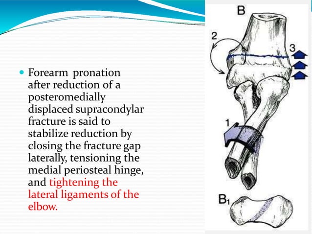 Distal humerus fracture in pediatrics by dr ashutosh | PPT