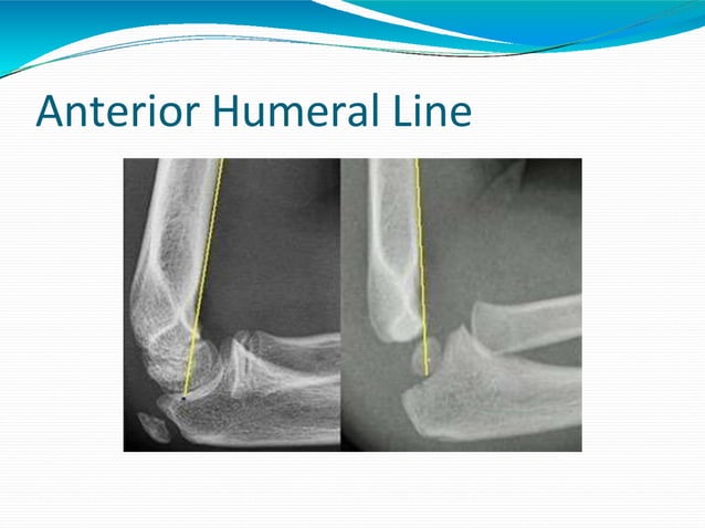 Distal humerus fracture in pediatrics by dr ashutosh | PPT