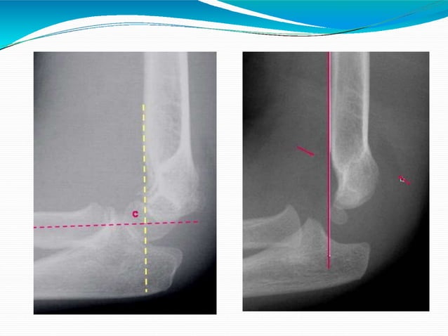 Distal humerus fracture in pediatrics by dr ashutosh | PPT