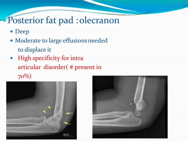 Distal humerus fracture in pediatrics by dr ashutosh | PPT