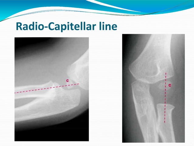 Distal humerus fracture in pediatrics by dr ashutosh | PPT