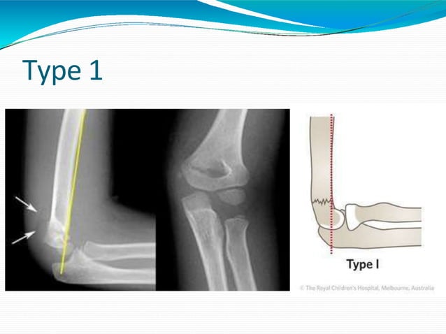 Distal humerus fracture in pediatrics by dr ashutosh | PPT