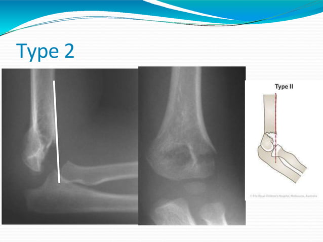 Distal humerus fracture in pediatrics by dr ashutosh | PPT
