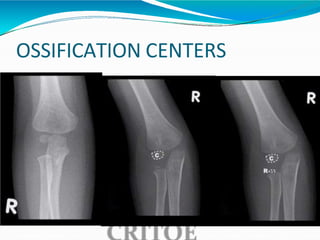 Distal humerus fracture in pediatrics by dr ashutosh | PPTX