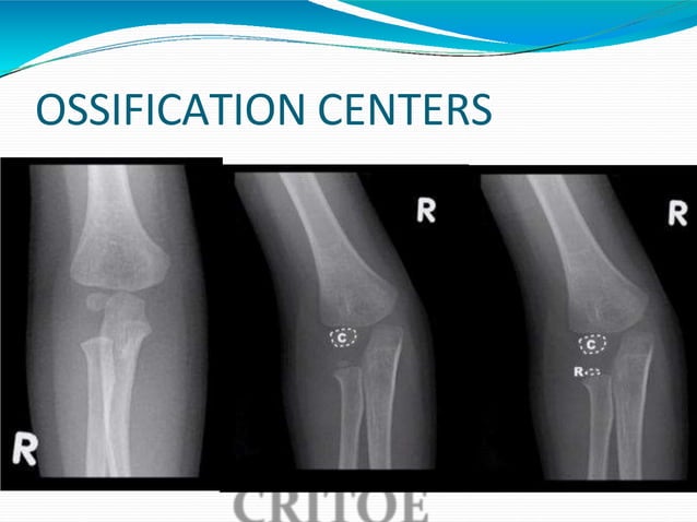 Distal humerus fracture in pediatrics by dr ashutosh | PPT
