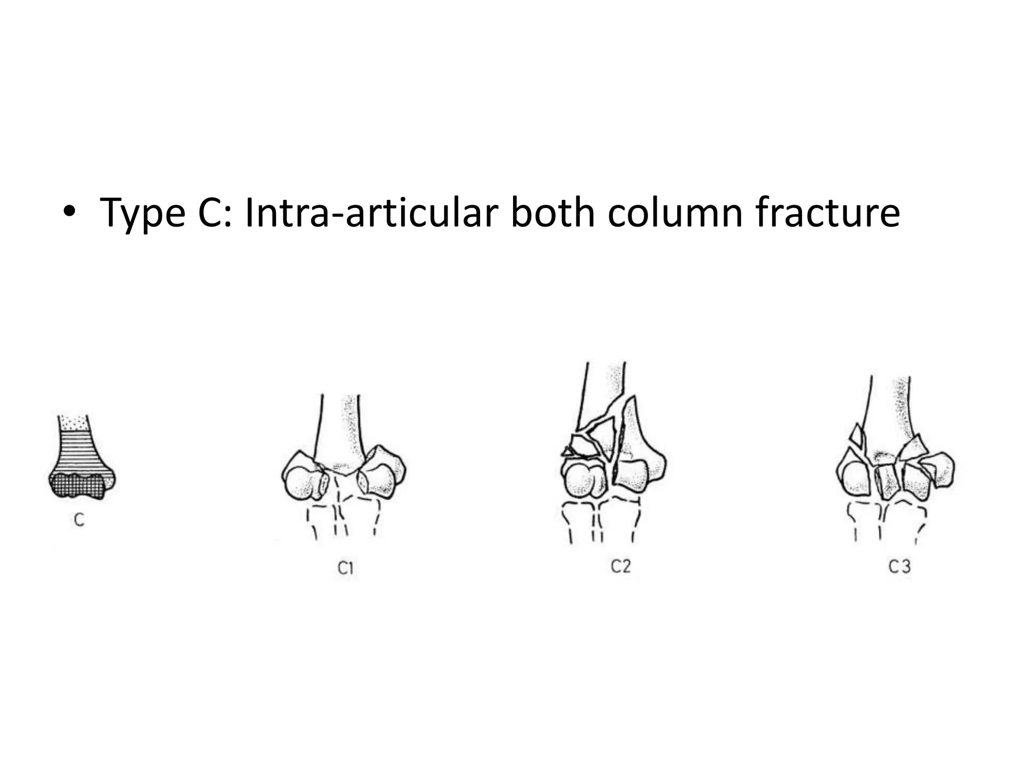 Distal humerus fractures | PPTX