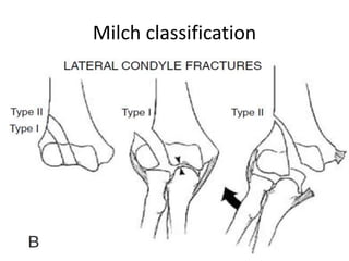 Distal humerus fractures | PPTX