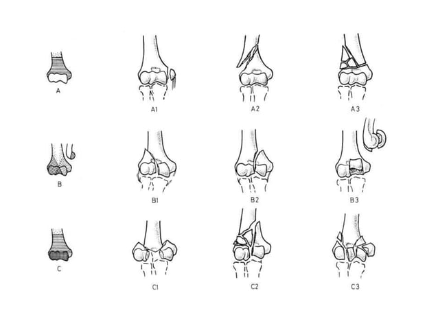Distal Humerus Fractures Classification Ao Ota Joint Journal Extremity ...