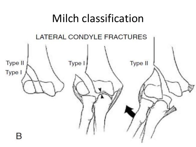 Distal humerus fractures