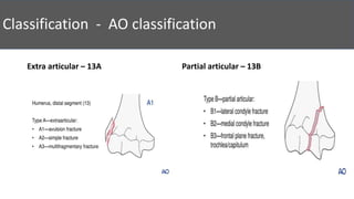 Distal Humerus Fractures.pptx