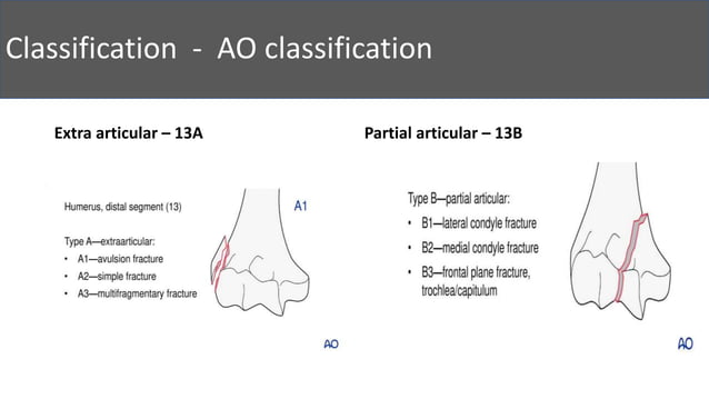 Distal Humerus Fractures.pptx
