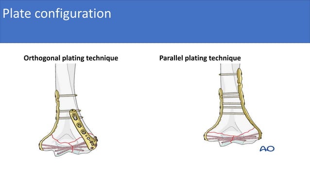 Distal Humerus Fractures.pptx