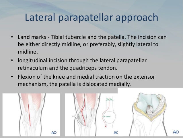 Distal Humerus Fractures.pptx