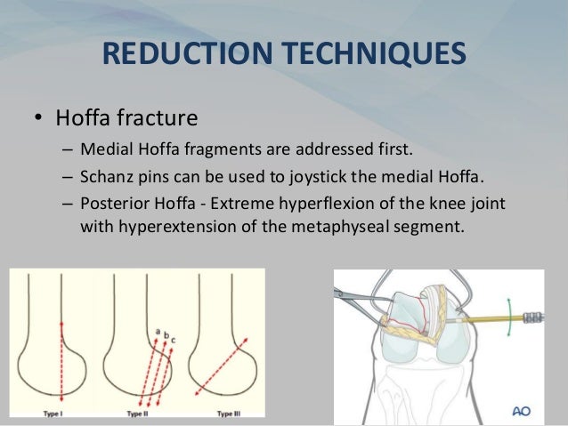 Distal Humerus Fractures.pptx