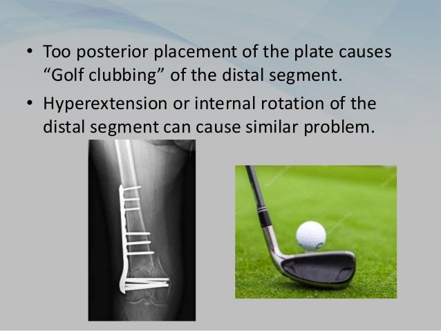 Distal Humerus Fractures.pptx