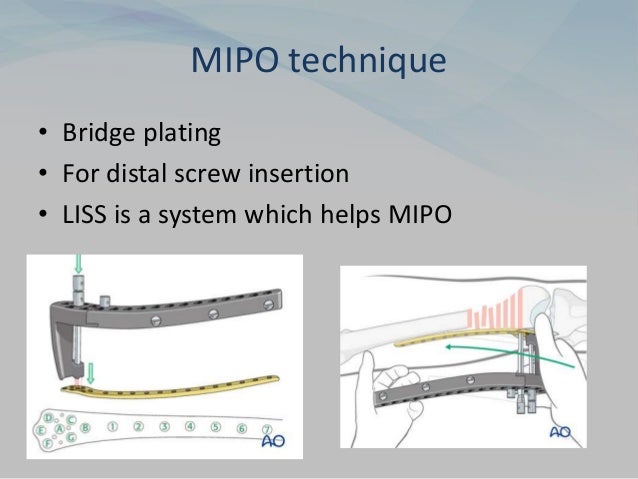 Distal Humerus Fractures.pptx