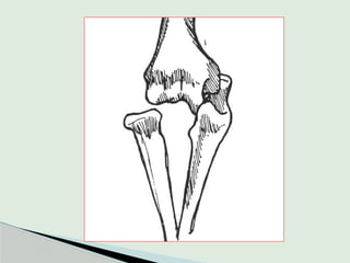 DISTAL HUMERUS FRACTURES AND ELBOW DISLOCATION.pptx