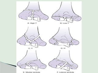 DISTAL HUMERUS FRACTURES AND ELBOW DISLOCATION.pptx