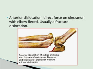 DISTAL HUMERUS FRACTURES AND ELBOW DISLOCATION.pptx