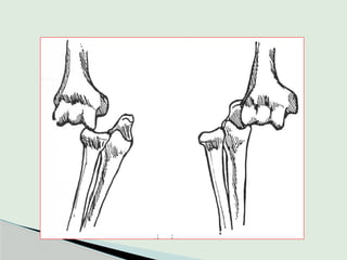 DISTAL HUMERUS FRACTURES AND ELBOW DISLOCATION.pptx