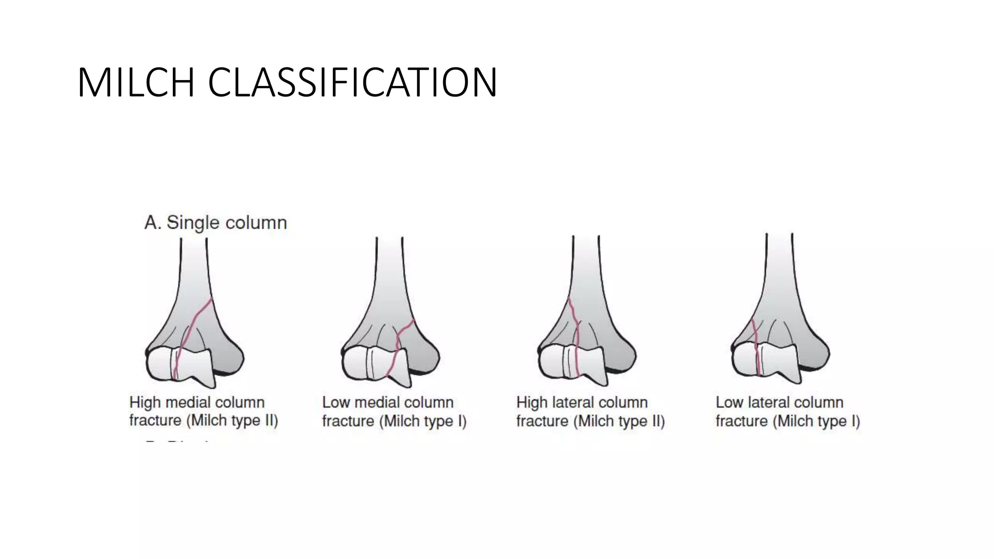 Distal humerus journal.pptx