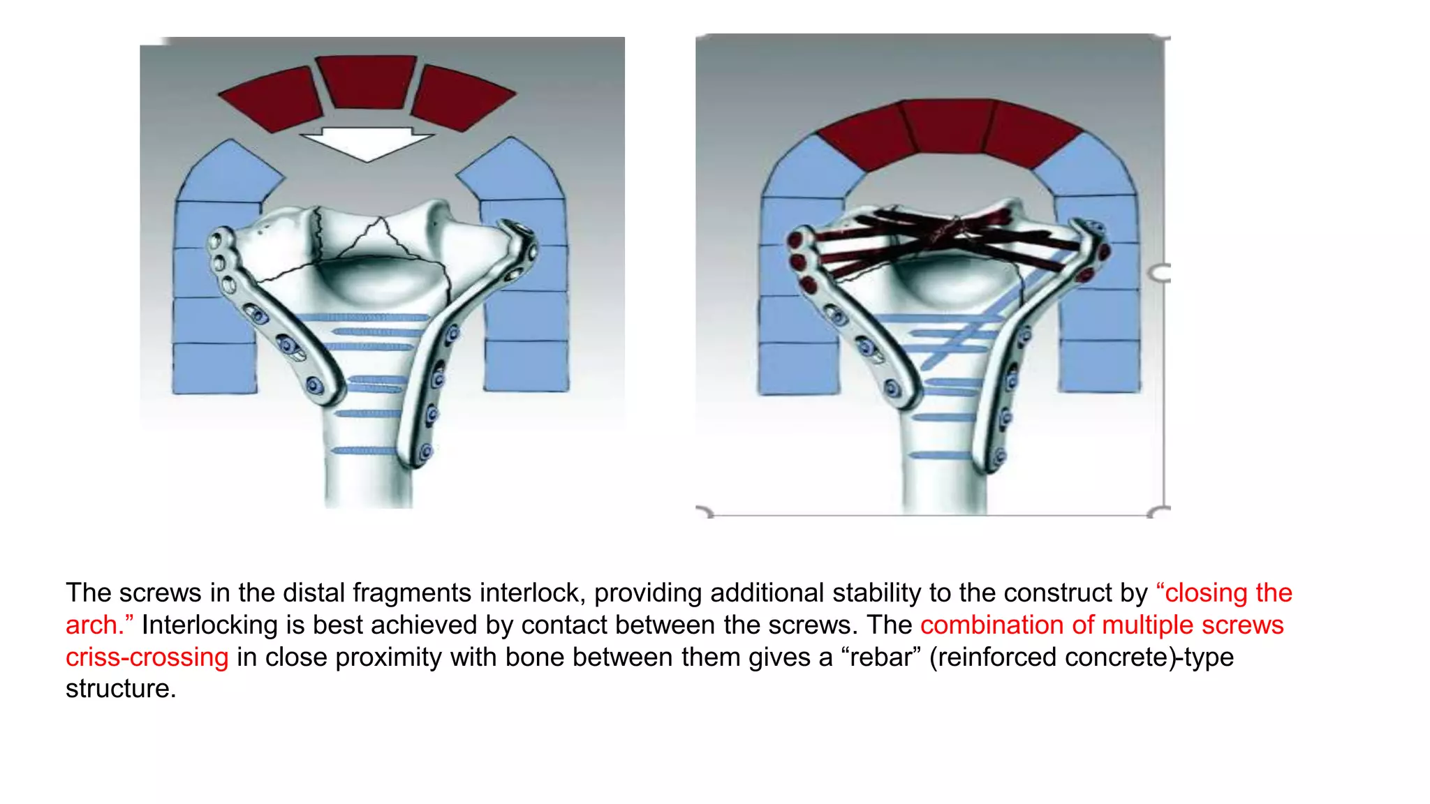 Distal humerus journal.pptx