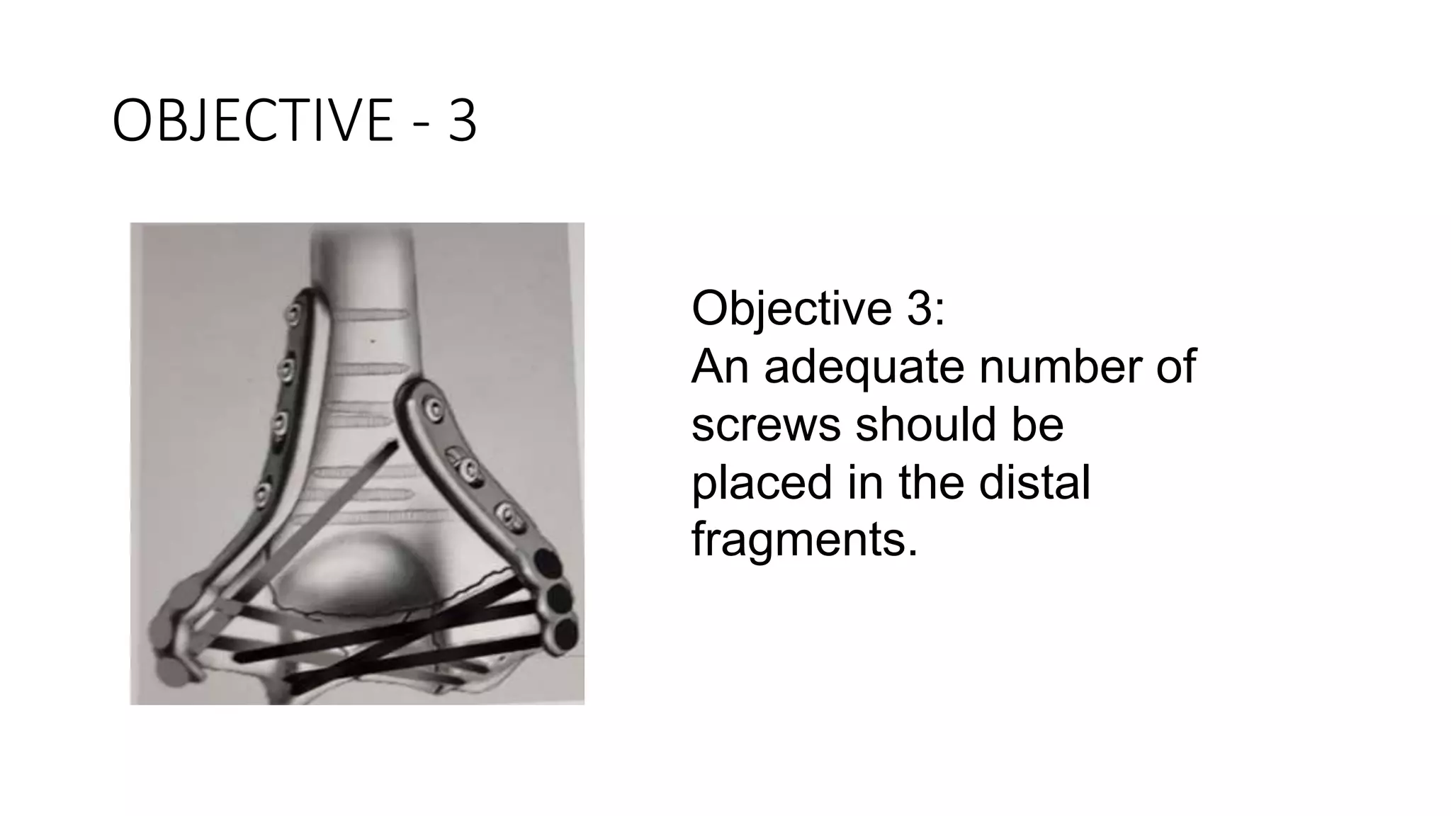 Distal humerus journal.pptx