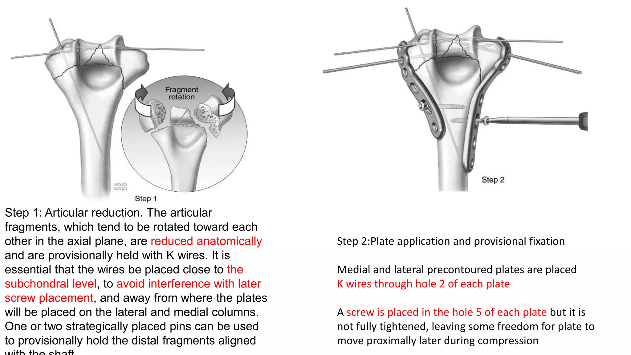 Distal humerus journal.pptx