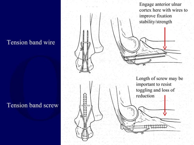 Distal humerus revised | PPT