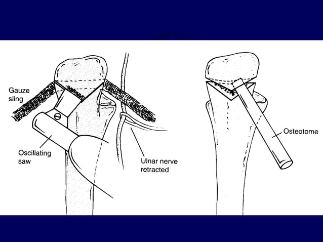Distal humerus revised | PPT