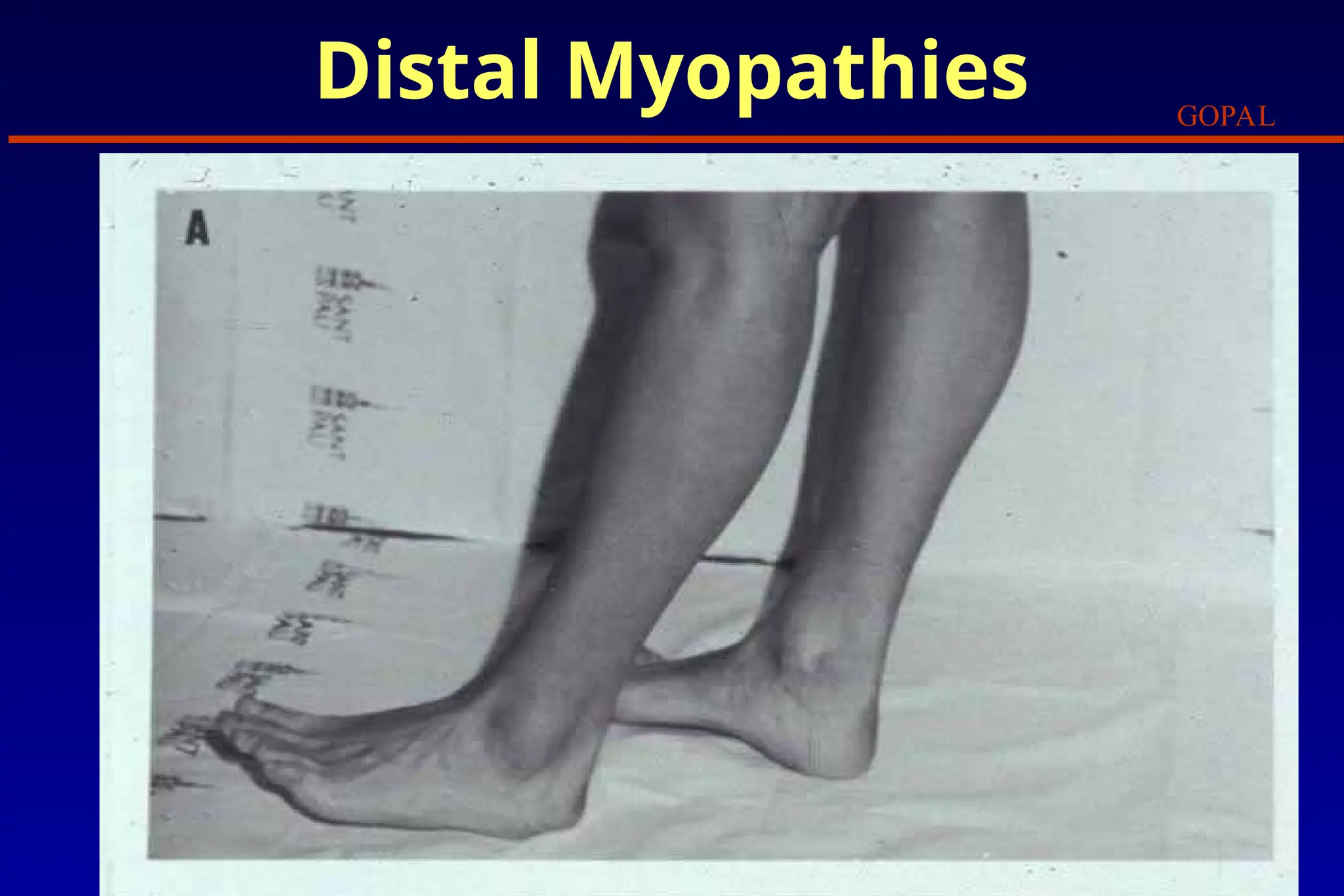 distal myopathies.ppt sms mc jaipur Rajasthan | PPT