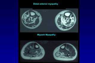 distal myopathies.ppt sms mc jaipur Rajasthan | PPT