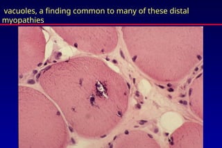 distal myopathies.ppt sms mc jaipur Rajasthan | PPT