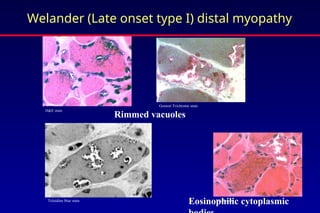 distal myopathies.ppt sms mc jaipur Rajasthan | PPT