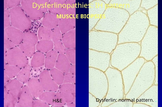 distal myopathies.ppt sms mc jaipur Rajasthan | PPT