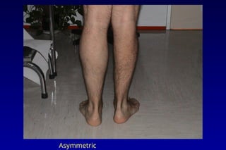 distal myopathies.ppt sms mc jaipur Rajasthan | PPT