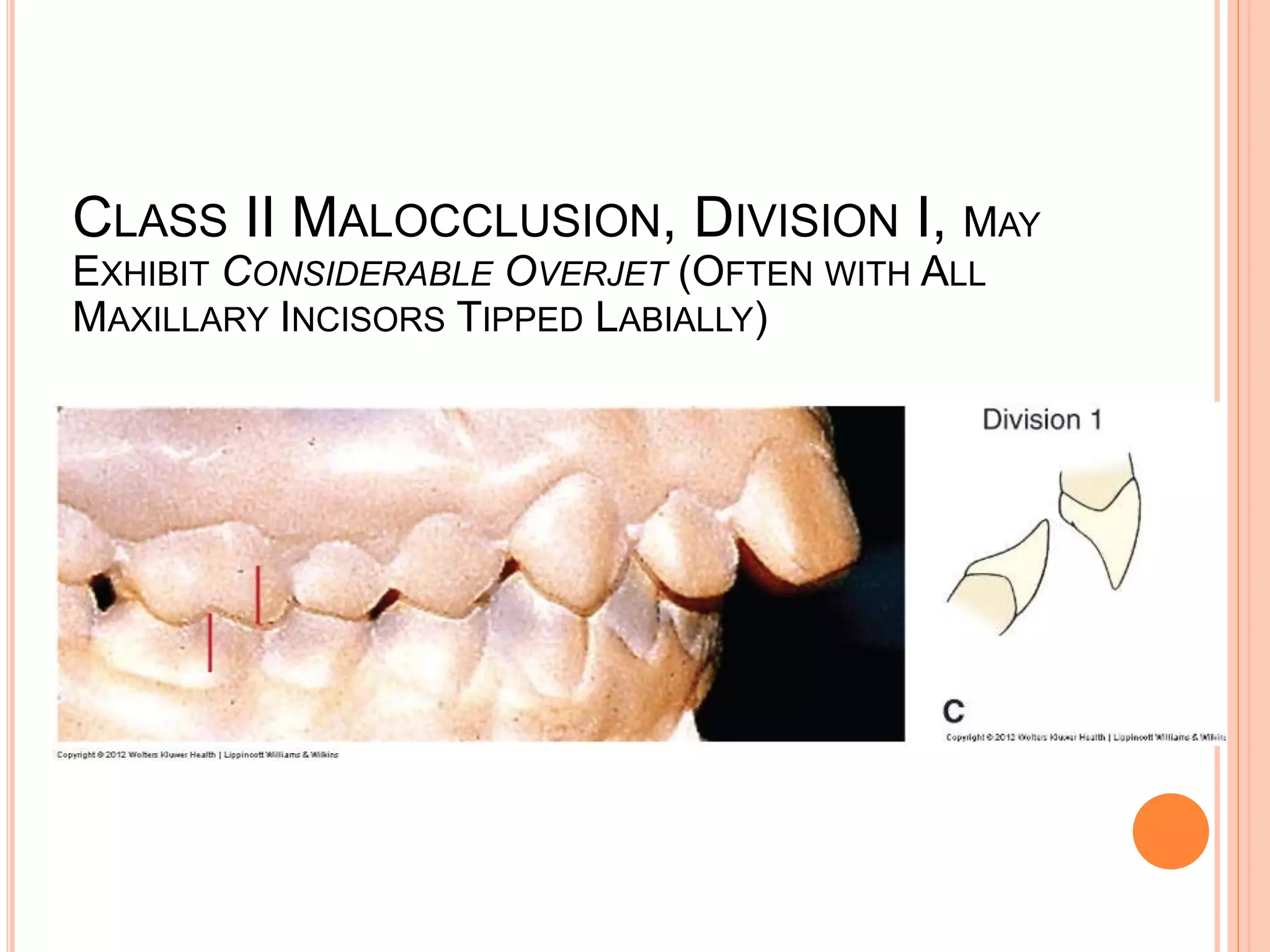 Distal occlusion | PPTX