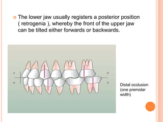 Distal occlusion | PPTX | Dental Health | Diseases and Conditions