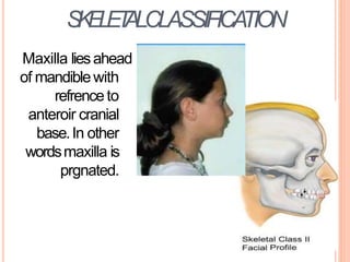 Distal occlusion | PPTX | Dental Health | Diseases and Conditions